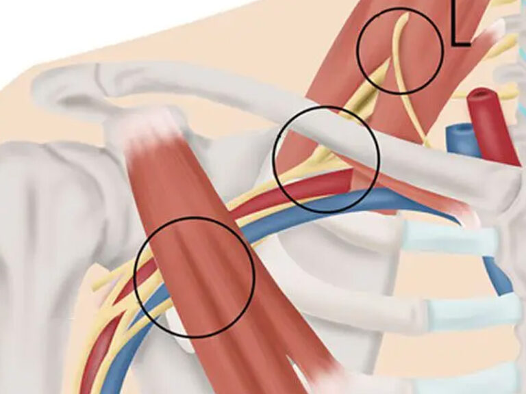 Thoracic Outlet Syndrome | Aiello Family Chiropractic | Brentwood TN